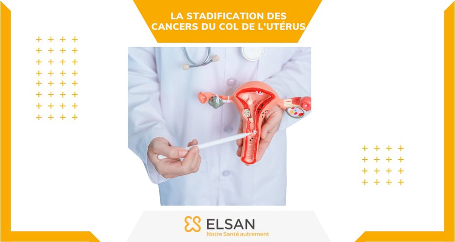 Cancer col utérus stade 1 à 4