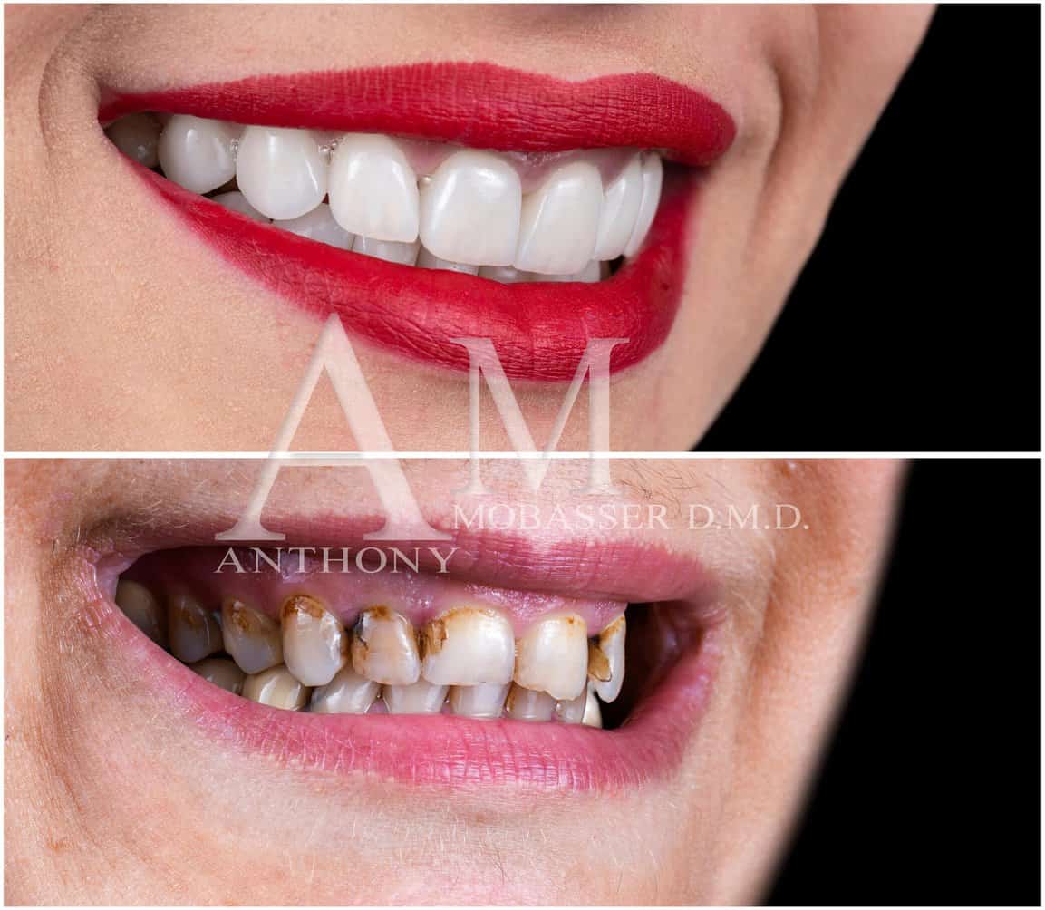 real teeth before veneers
