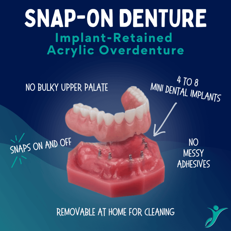 options for upper dentures