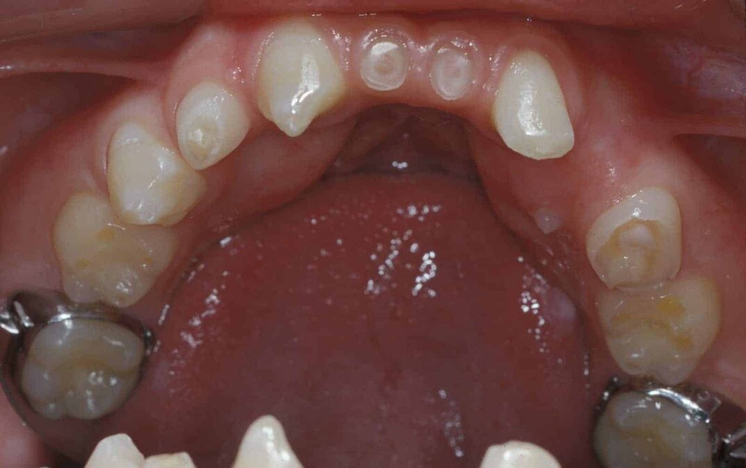 congenitally missing teeth