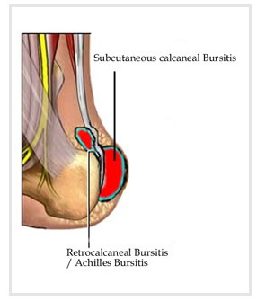 subcutaneous ankle