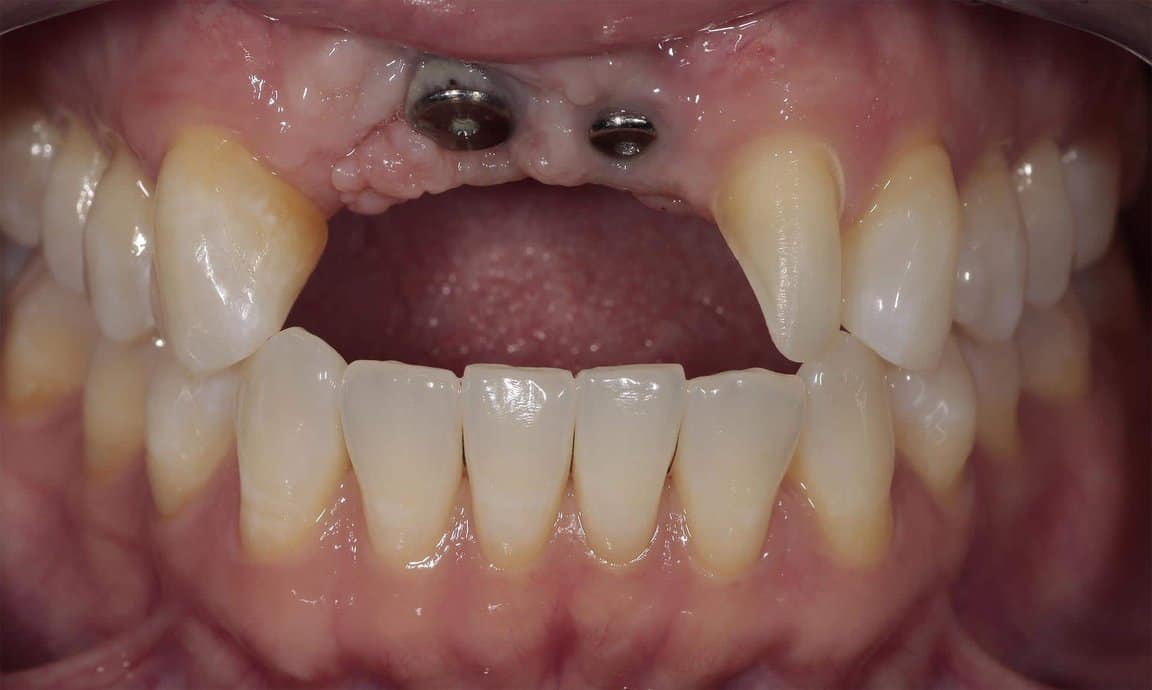 Dental Implants in Los Angeles | Dr. Anthony Mobasser