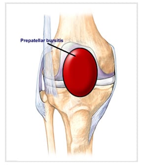 prepatellar bursitis surgery