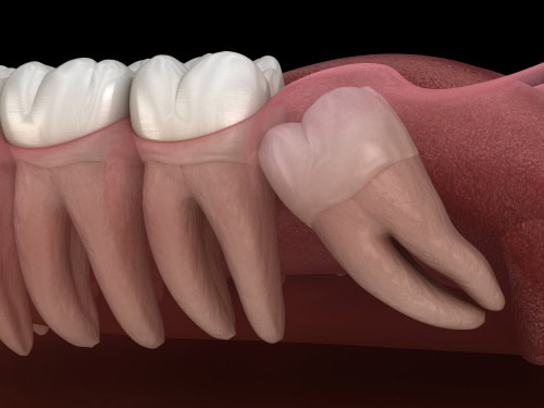 impacted teeth extraction