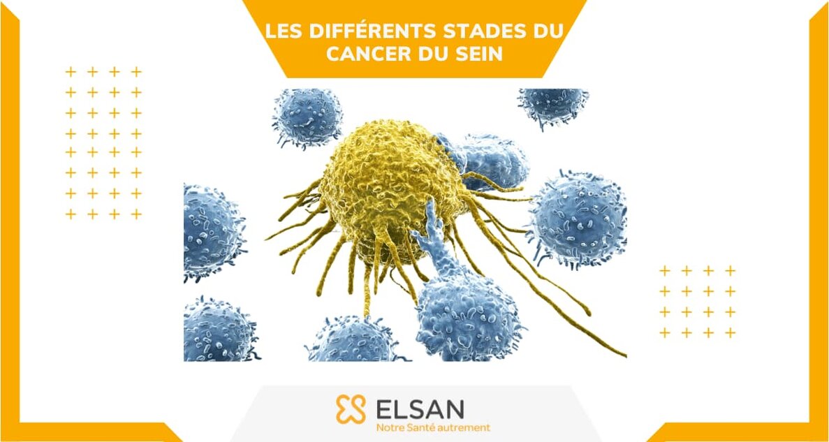La classification et les différents stades du cancer du sein - Institut ...