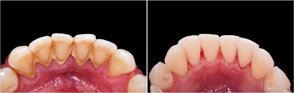 gingivitis before and after