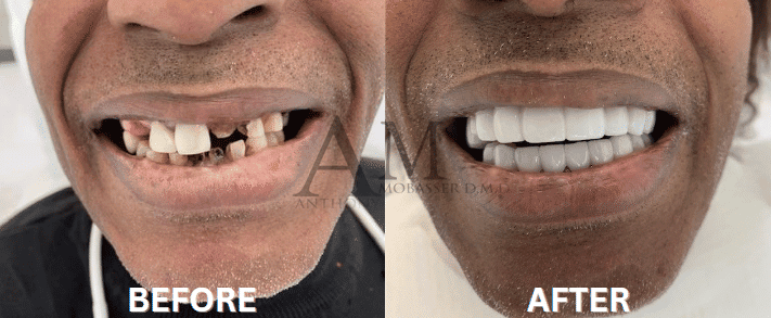 bulky veneers