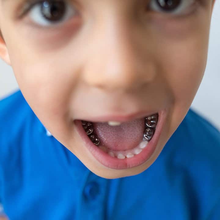 Stainless Steel Crowns For Kids | Atria Dental Gordon