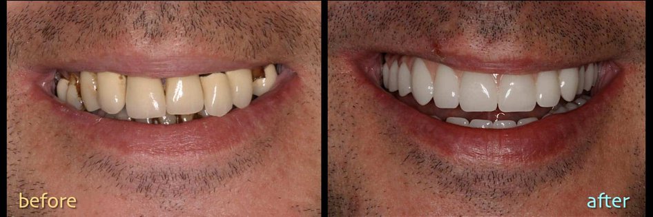 fabolous teeth fixed