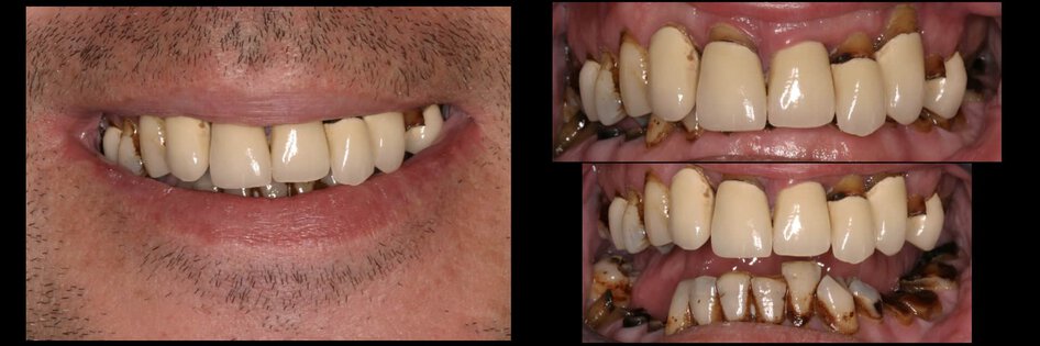 fabolous teeth fixed