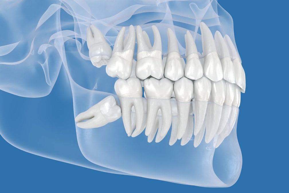 wisdom teeth extraction