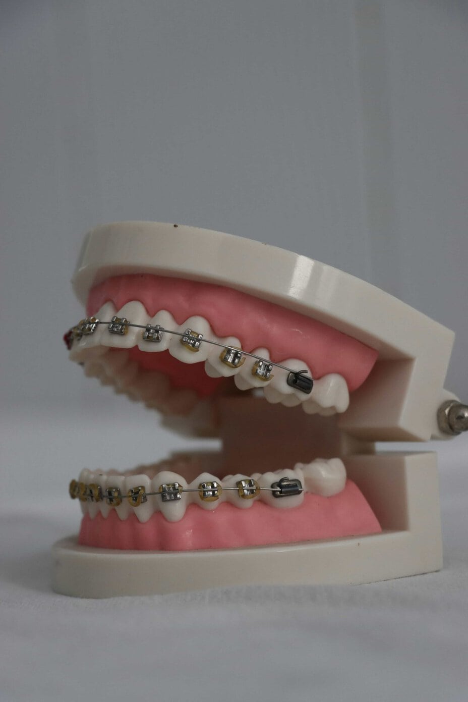 The Best Color Combinations For Braces: Our Recommendations