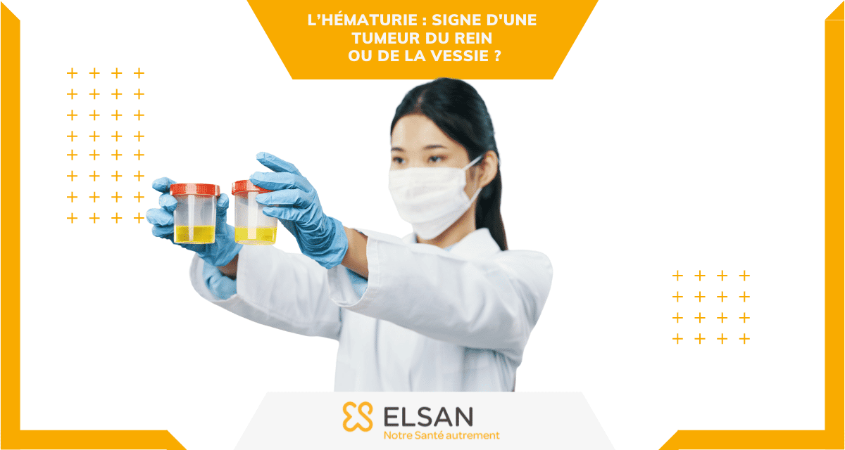 Hématies dans les urines : fatigue et symptôme du cancer vessie et du rein
