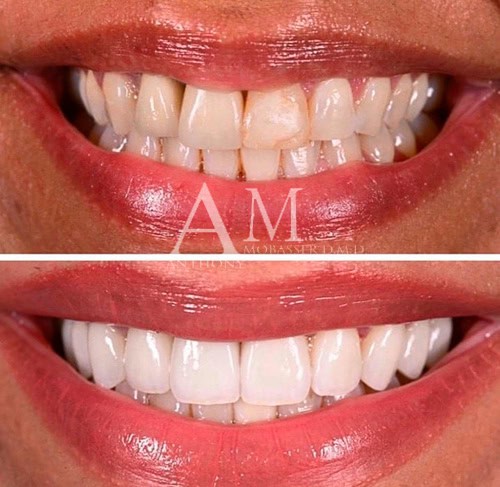 veneers epsom