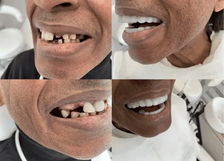 extreme teeth makeover