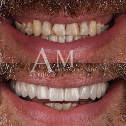 extreme teeth makeover