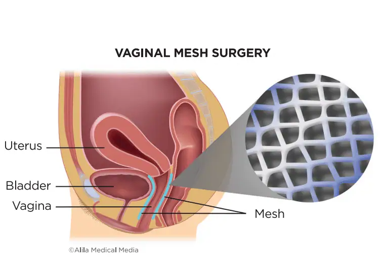 Vaginal Prolapse Repair Surgery using Mesh/Biological Graft - Brazosport Women's Health