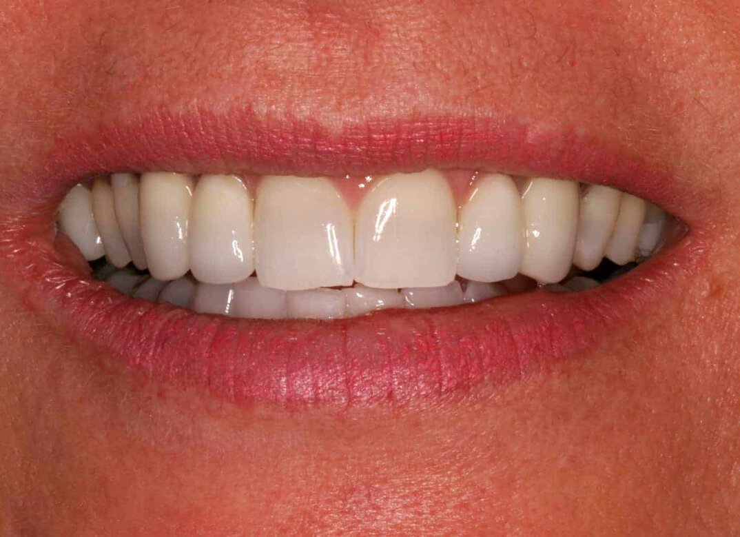 anterior fixed partial denture