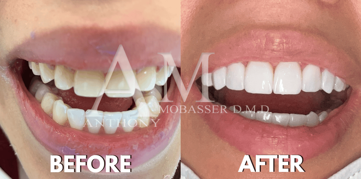 brandy remove veneers