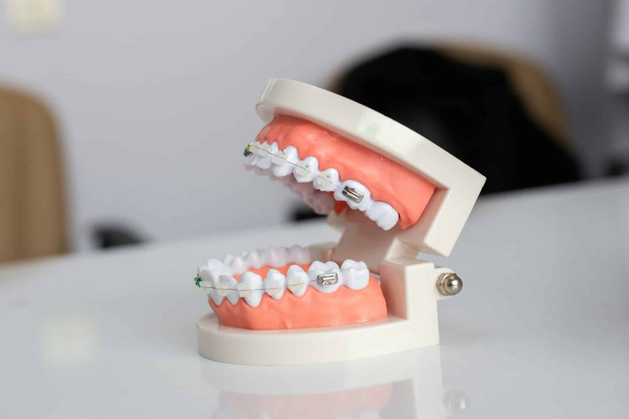 Types Of Brace Brackets And Their Uses For Your Teeth