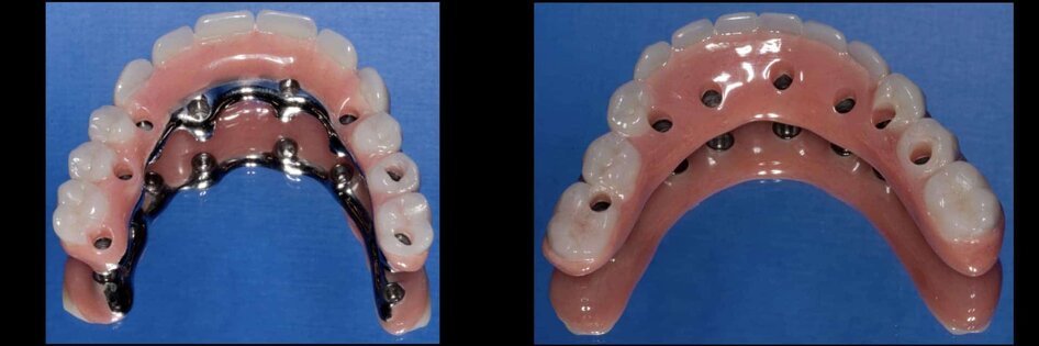 complete dentures maxillary